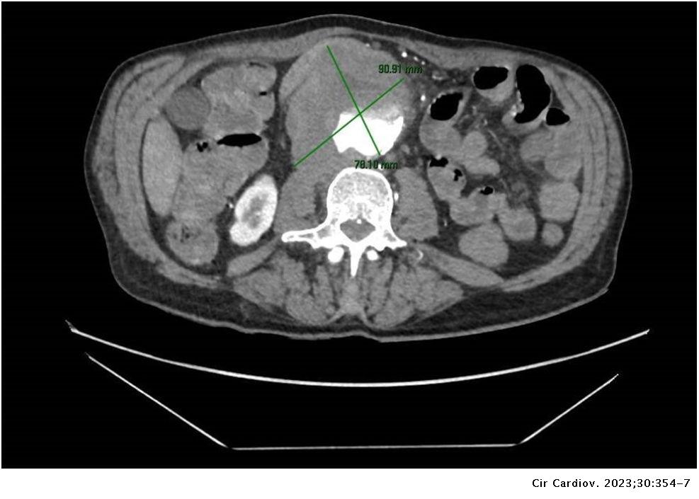 Fístula aortoentérica tratada y resuelta con abordaje híbrido ...